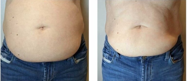 Before & After - El Con Health and Wellness